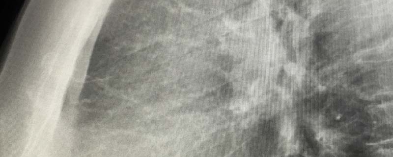 Mass In The Lungs On Chest X-Ray – Radiology In Plain English