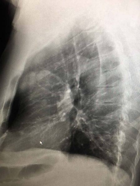 Broken Rib on X-ray – Radiology In Plain English