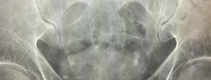 Small Calcifications In The Pelvis On X-Ray – Radiology In Plain English