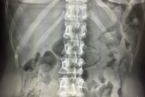 Non-Specific Bowel Gas Pattern – Radiology In Plain English