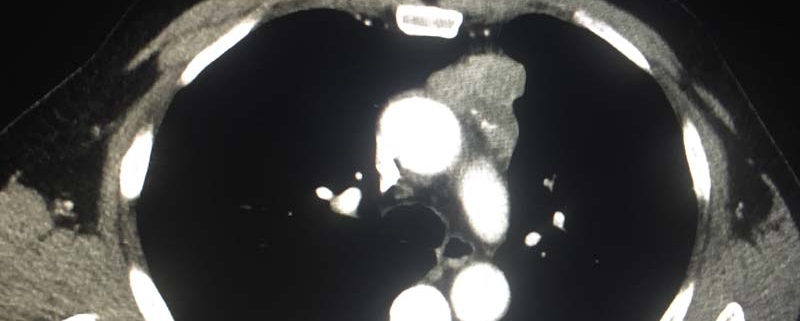 Anterior Mediastinal Mass On CT – Radiology In Plain English