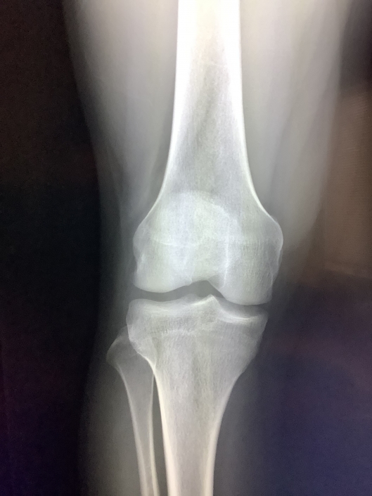 Modified Barium Swallow Exam (Cookie Swallow) – Radiology In Plain English