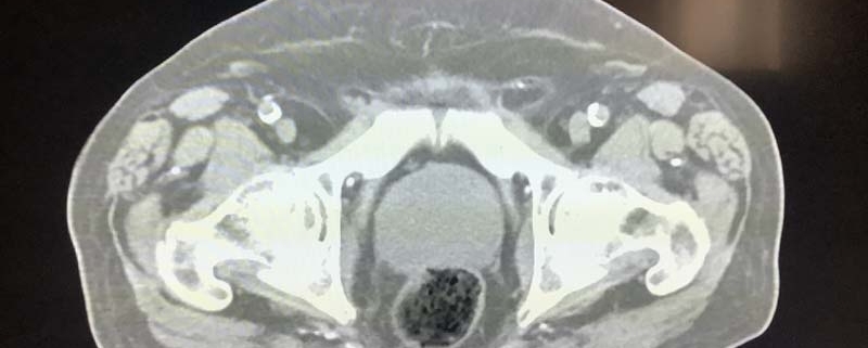 Enlarged Prostate On CT – Radiology In Plain English