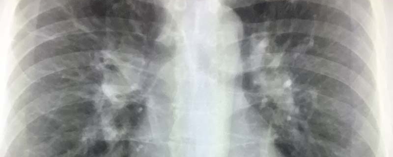 Bilateral Hilar Prominence On Chest X-Ray – Radiology In Plain English