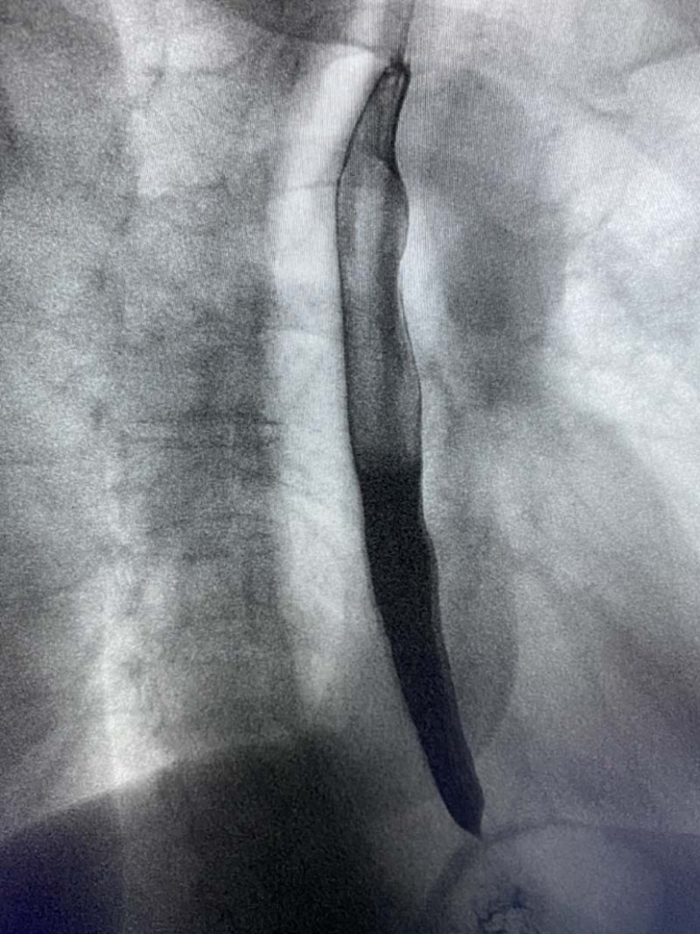 Hazy Opacities In Lungs Meaning – Radiology In Plain English