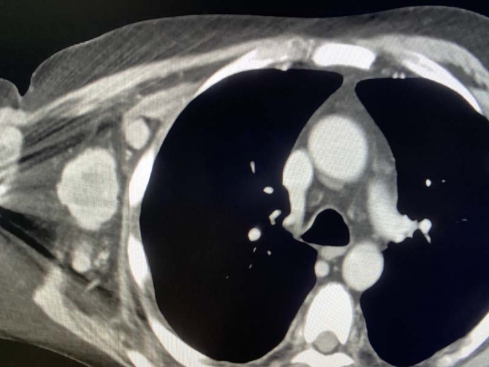 Density on Chest X-ray – Radiology In Plain English