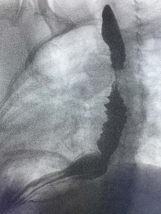 Tertiary Contractions and Abnormal motility On Esophogram – Radiology ...