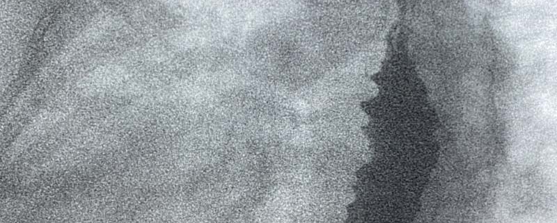 Tertiary Contractions and Abnormal motility On Esophogram – Radiology ...